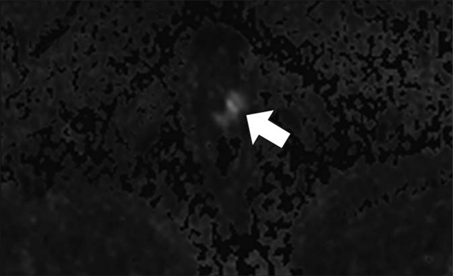 Nomograms for Stratifying Prostate Cancer Risk—Where Imaging Changes ...